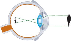 Synfel - Läs om de vanligaste synfelen